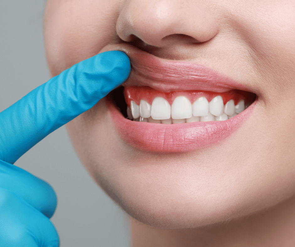 Tissue Grafting